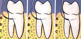 FURCAS | FISURAS | HEMISECCIONES | REIMPLANTE | VITORIA