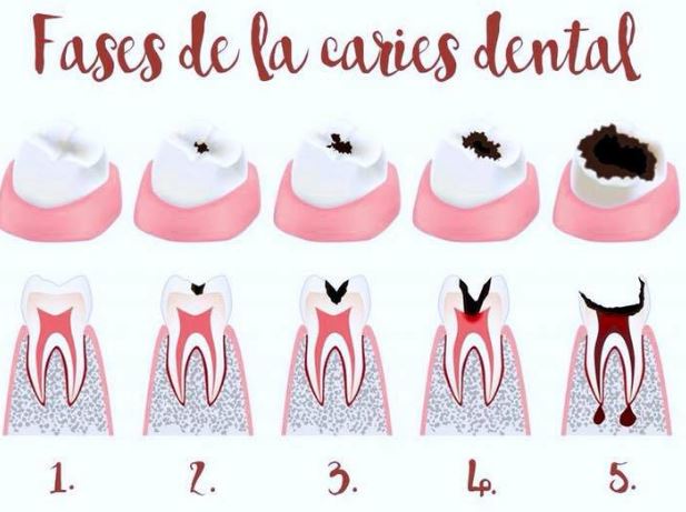 Caries, ¿qué son y qué las causan? | Clínica Dental Mozas