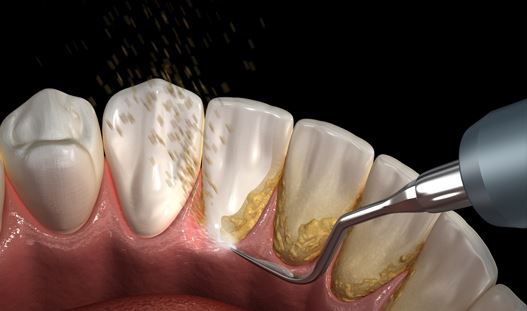 ¿Sabes qué es el periodonto? | Clínica Dental Mozas