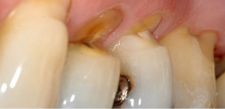 Dientes desgastados | Clínica Dental Mozas en Vitoria-Gasteiz