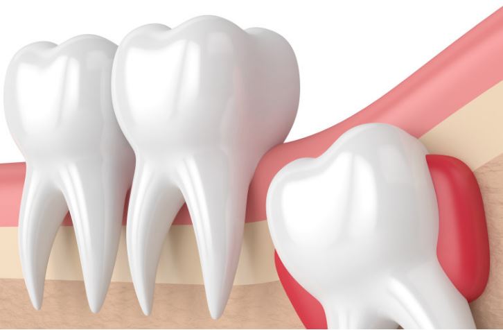 Como aliviar el dolor de las muelas del juicio | Clínica Dental Mozas