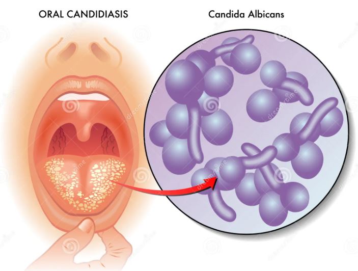 Candidiasis oral: Qué es y cómo prevenirla | Clínica Dental Mozas