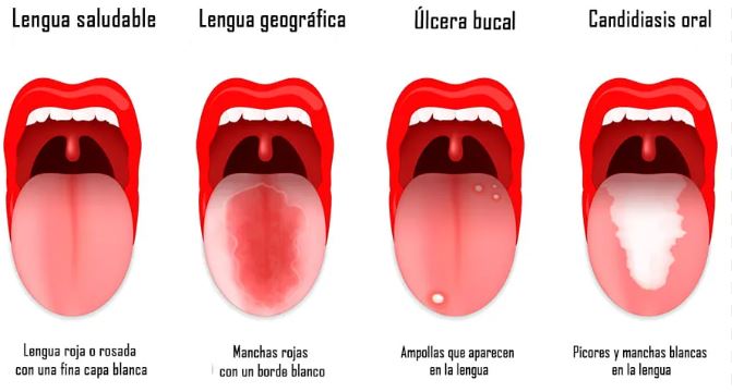 ¿Tengo sana la lengua? | Clínica Dental Mozas en Vitoria